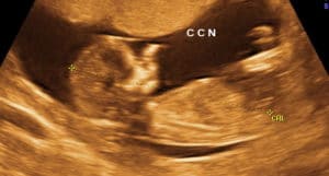 CRL | Fetalmed - Medicina Fetal em Curitiba