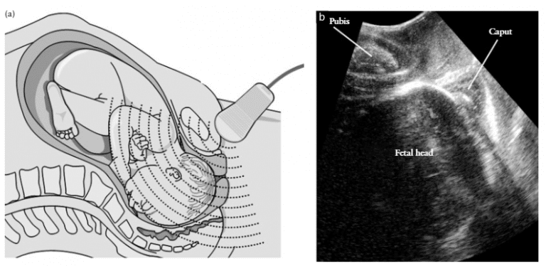 Diagnóstico da Altura e Apresentação do Polo Cefálico Fetal
