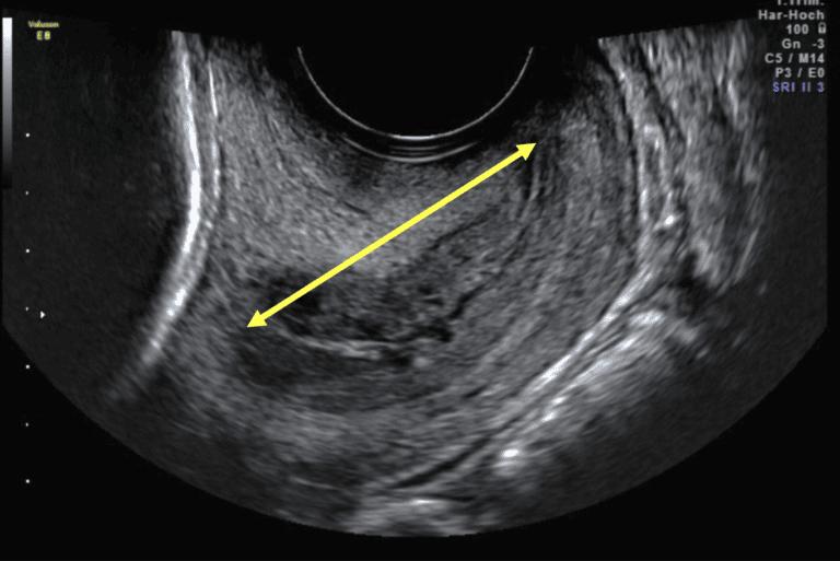 Tabela Comprimento Colo Uterino | Fetalmed