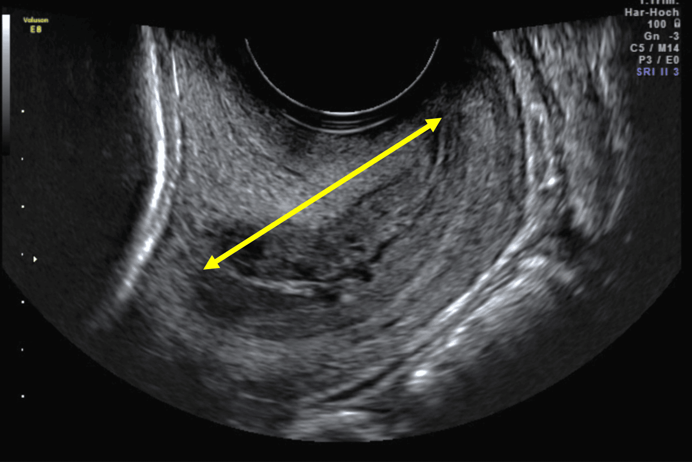 Tabela Comprimento Colo Uterino | Fetalmed Tabela Comprimento Colo Uterino | Fetalmed