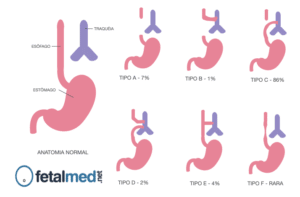 Atresia de esôfago | Fetalmed - Medicina Fetal em Curitiba