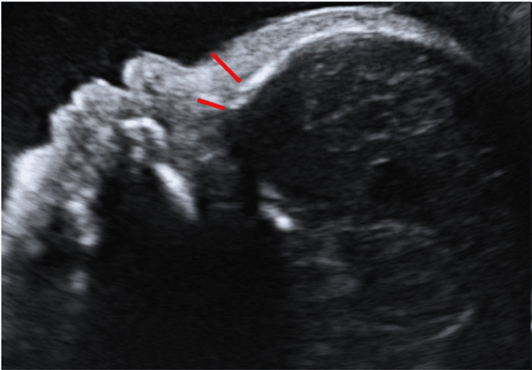 A Utilização da Relação Espessura Prenasal/Comprimento do Osso Nasal ...