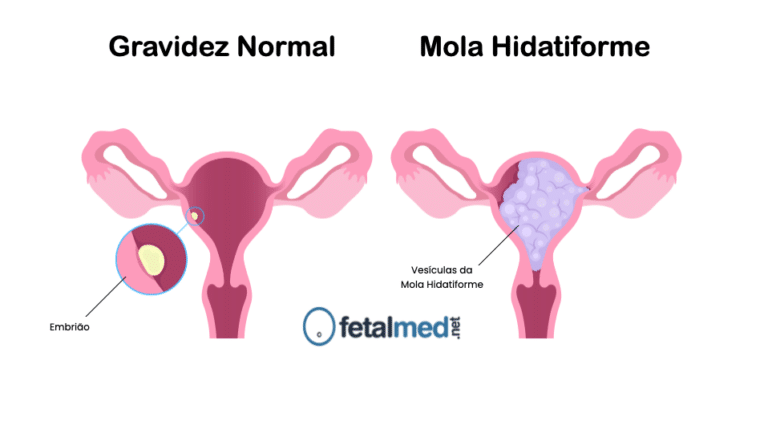 Tudo sobre Mola Hidatiforme | Fetalmed